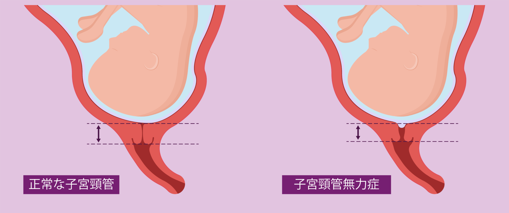 切迫早産の症状となりやすい人の特徴 - 新型出生前診断（NIPT）− DNAサイエンス